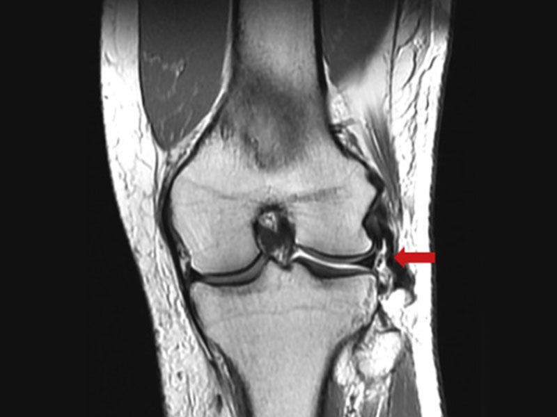 Primary Repair of the Lateral Collateral Ligament | Dr Gregory Difelice ...